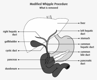 Diagram Of What Is Removed In A Modified Whipple Procedure - Modified ...