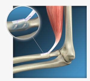 Endoscopic Distal Biceps Reinsertion Surgery, Toulouse - Rotura Del ...