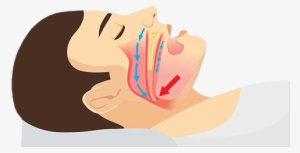What Is Obstructive Sleep Apnea - Sleep Apnea Png - Free Transparent ...
