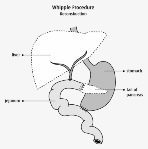 Diagram Of Reconstruction In A Whipple Procedure ...