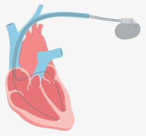 Systolic Heart Failure Also Called Systolic Left Ventricular - Labeled ...