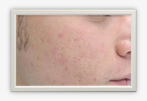 This Involves Using A Needle Or Cannula To Break The - Freckle - Free ...