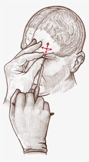 Transorbital Lobotomy A Doctor Inserted A Tool Similar - Trans Orbital ...