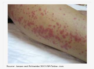 Skin Rashes - - Leptospirosis Skin Rash - Free Transparent PNG Download ...