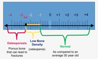 Understanding Bone Density Results - Free Transparent PNG Download - PNGkey