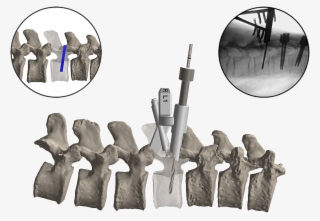 Firefly Pedicle Screw Navigation Guide - Free Transparent PNG Download ...