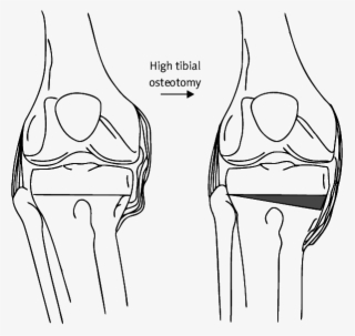 Example Of High Tibial Osteotomy Used For Varus Knee - High Tibial ...
