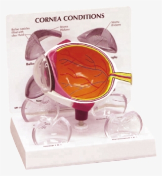 Human Eye Model With Pathological Cornea - Cornea On A Model - Free ...