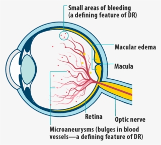 Picture Of Effects Of Dme/dr In Dme On The Eye, Showing - Diagram ...