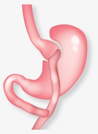 Illustration Of Gastric Bypass - Balloon - Free Transparent PNG ...