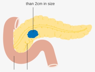 P Pancreatic Cancer - Diagram - Free Transparent PNG Download - PNGkey