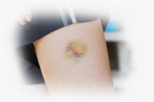 Bruise PNG, Transparent Bruise PNG Image Free Download - PNGkey